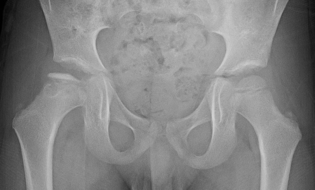 Adventures with Legg Calve Perthes Disease: X-RAYS