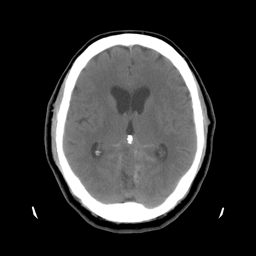 X-RAYview: Hemorragia SUBARACNOIDEA