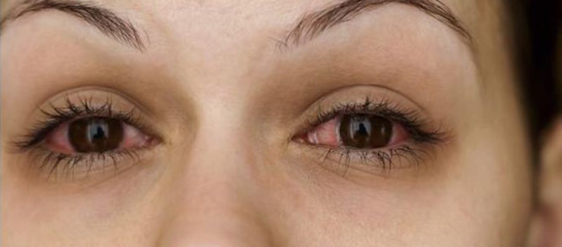 Lupus Hope | Living Hopefully With Lupus: Lupus Disease – How to ...