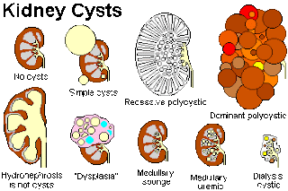 Kidney disease cure: Detailed renal cysts