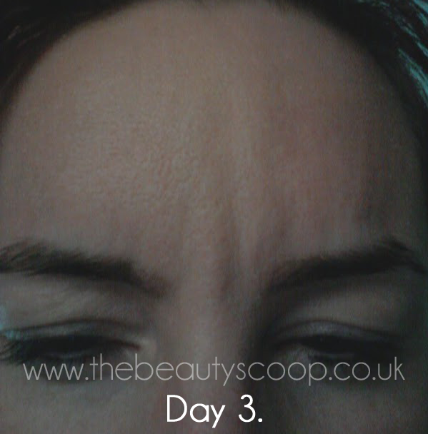 The Beauty Scoop!: The Botox Diaries - Days 1 to 4!