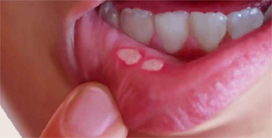 AFTA Causas, Sintomas e Tratamento - Enfermagem