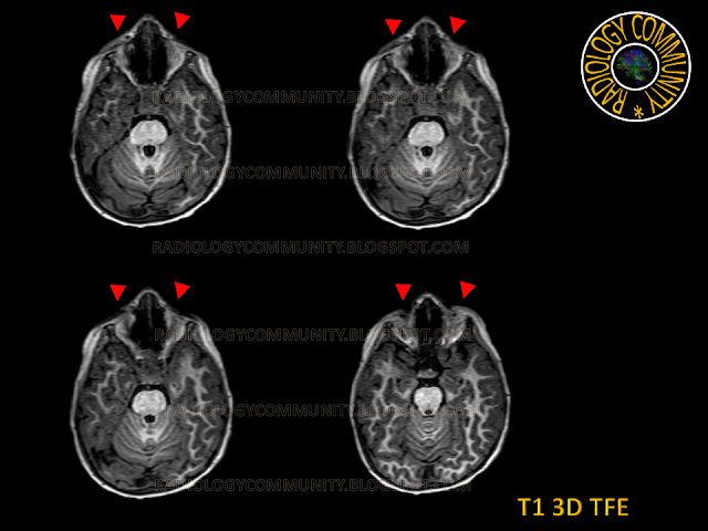 Radiology Community: MRI εγκεφάλου σε ασθενή με συγγενή απλασία ...