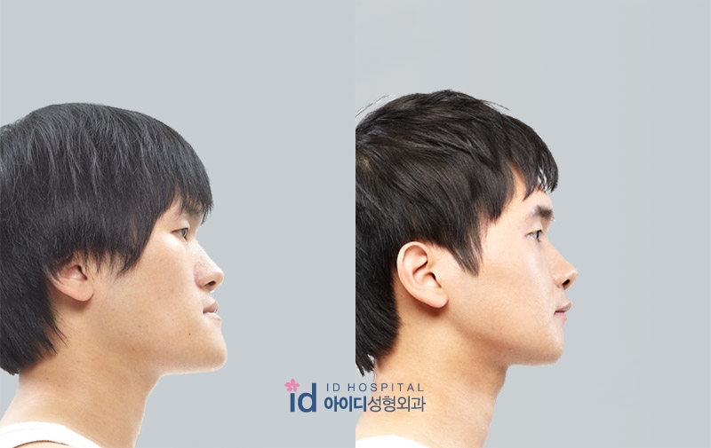 ID Hospital Korea: FAQ Double Jaw Surgery! All your questions answered ...
