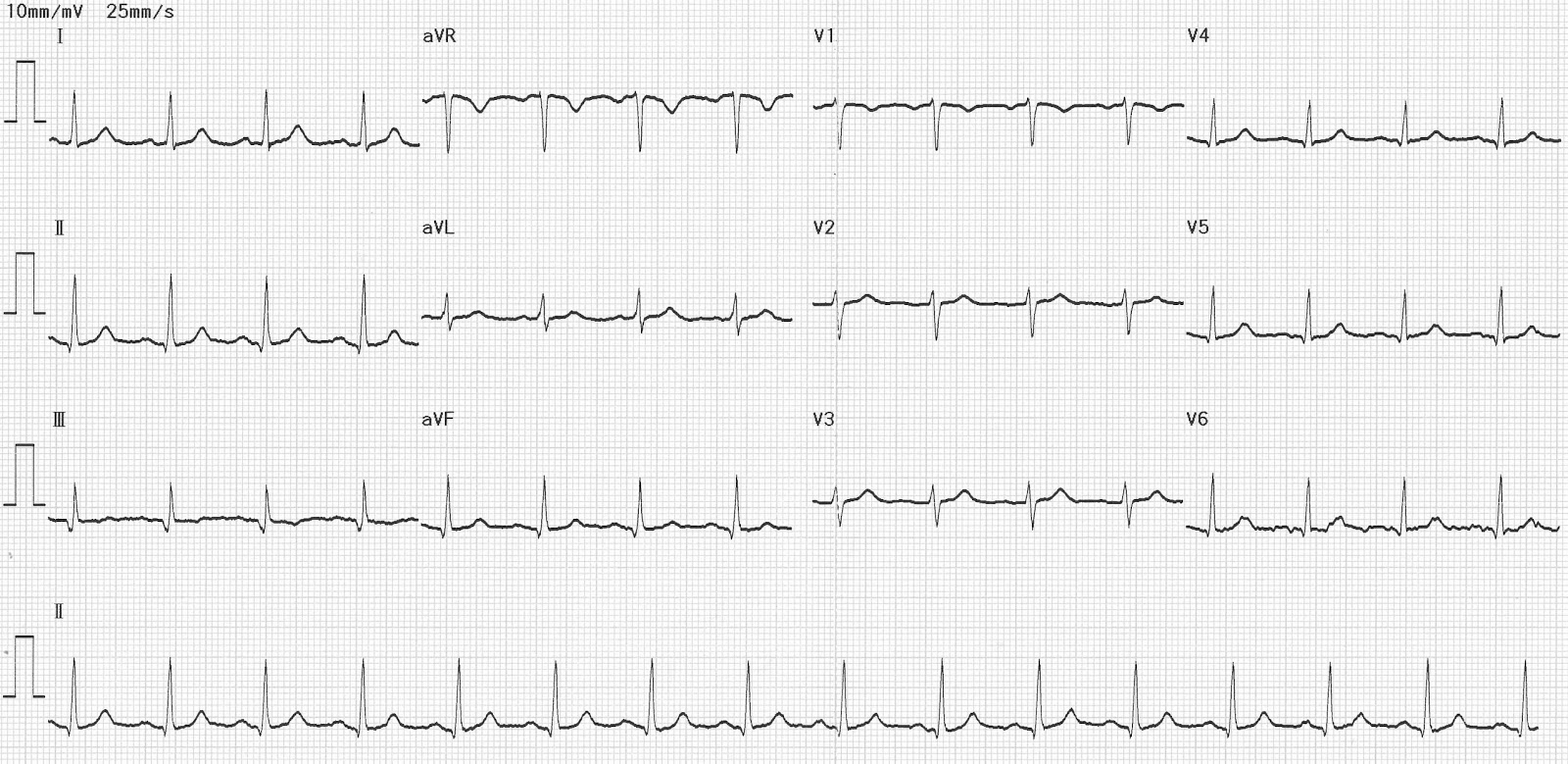 ECG of the Week: ECG of the Week - 28th November 2016 - Interpretation