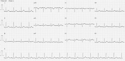 ECG of the Week: ECG of the Week - 28th November 2016 - Interpretation
