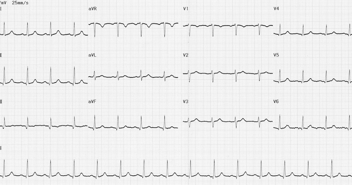 ECG of the Week: ECG of the Week - 28th November 2016 - Interpretation