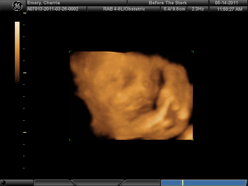 Making mEmerys: 3D/4D Ultrasound-30 Weeks
