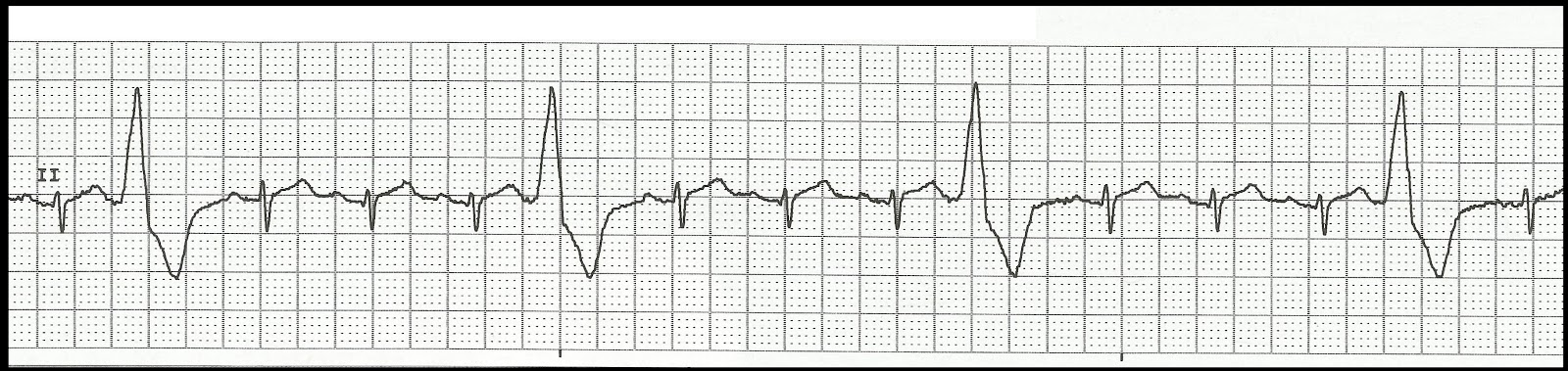 Float Nurse: EKG Rhythm Strip Quiz 104