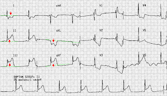 Belajar EKG cepat 20 menit Gratiss ~ BelajarEKG