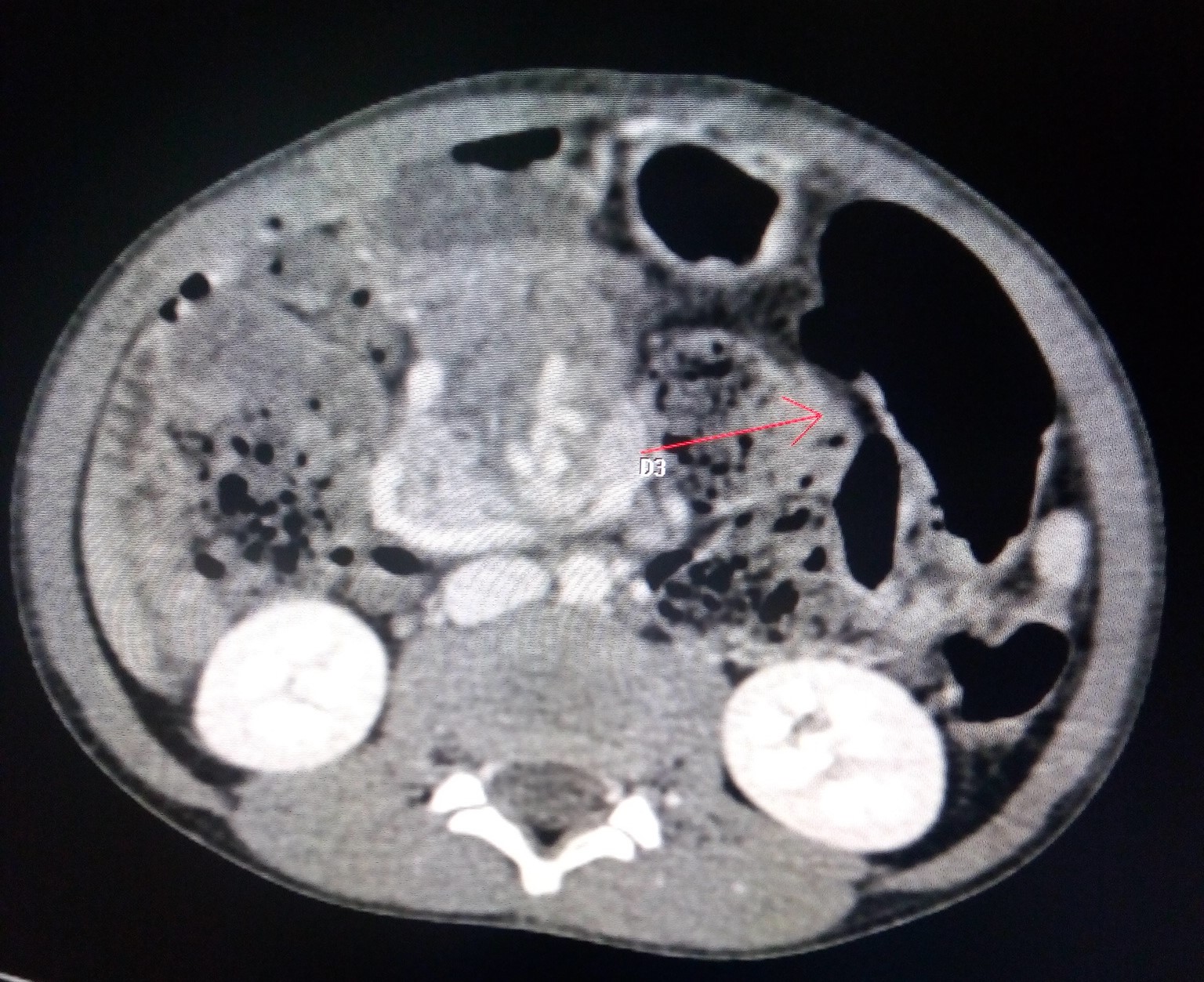 Midgut Volvulus CT - Sumer's Radiology Blog