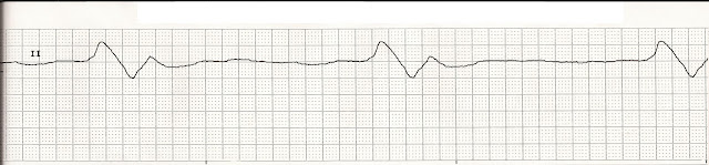 Identify the appropriate electrical intervention for the following EKG ...