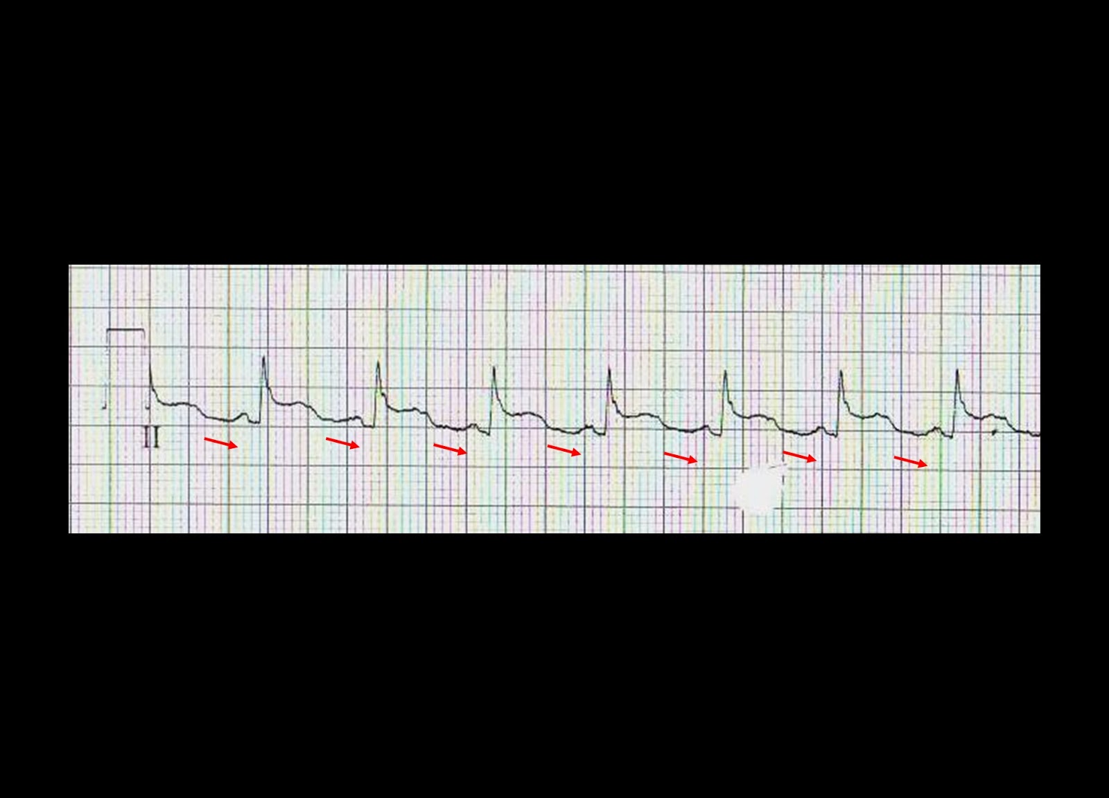 Andrew R. Houghton: Spodick's sign: Downsloping TP segment in pericarditis