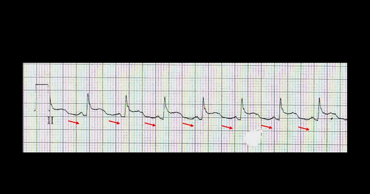 Andrew R. Houghton: Spodick's sign: Downsloping TP segment in pericarditis