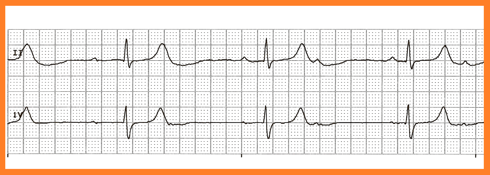 Basic EKG Rhythm Test 21 (Heart Block Challenge)