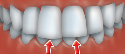 Surrideo Orthodontics - Damon Braces - Invisalign - Incognito: Glossary ...