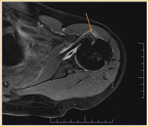 Long Head Biceps Tear-MRI - Sumer's Radiology Blog