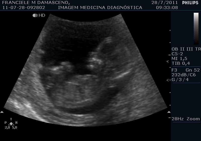 Imagens De Ultrassom De 3 Meses