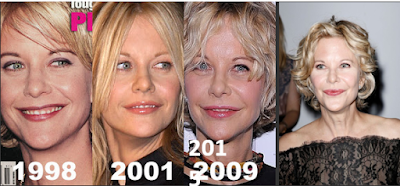 Meg Ryan Plastic Surgery Before and After Facelift and Botox - Star ...