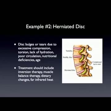 MAKLUMAT KESIHATAN DAN PENYAKIT: Sakit Saraf Sciatica 1 (urat di antara ...