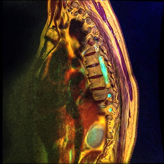 Nevit's blog: Dorsal Spine Color MRI
