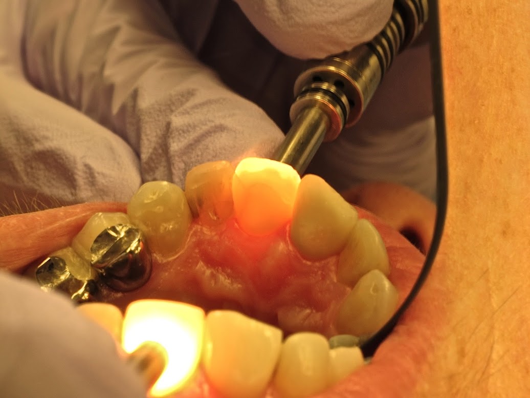 All Things Dentistry: Episode 374/500: Cracked Tooth Transillumination