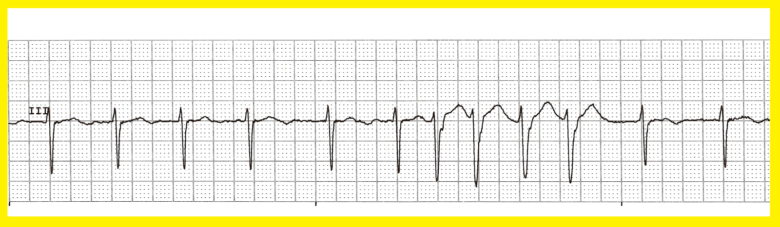 Various Atrial Fibrillations