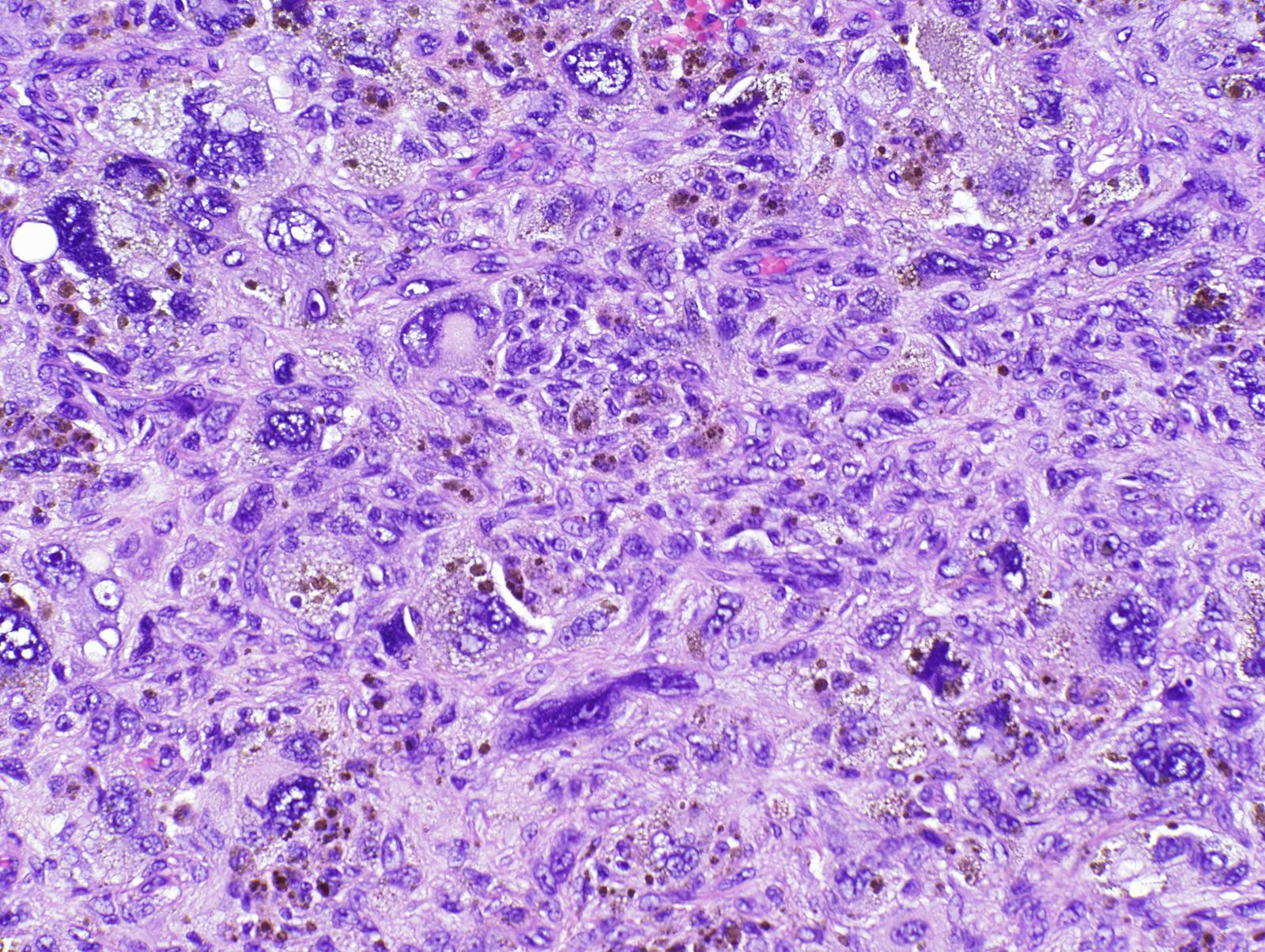 VIRTUAL GRAND ROUNDS IN DERMATOLOGY 2.0: Dermatofibroma with Monster Cells