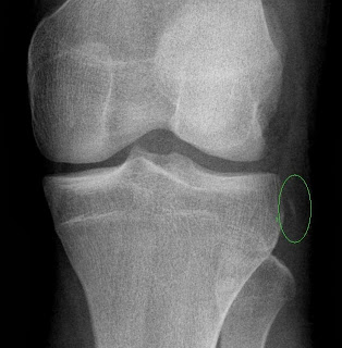 MedicoNotebook: Segond fracture