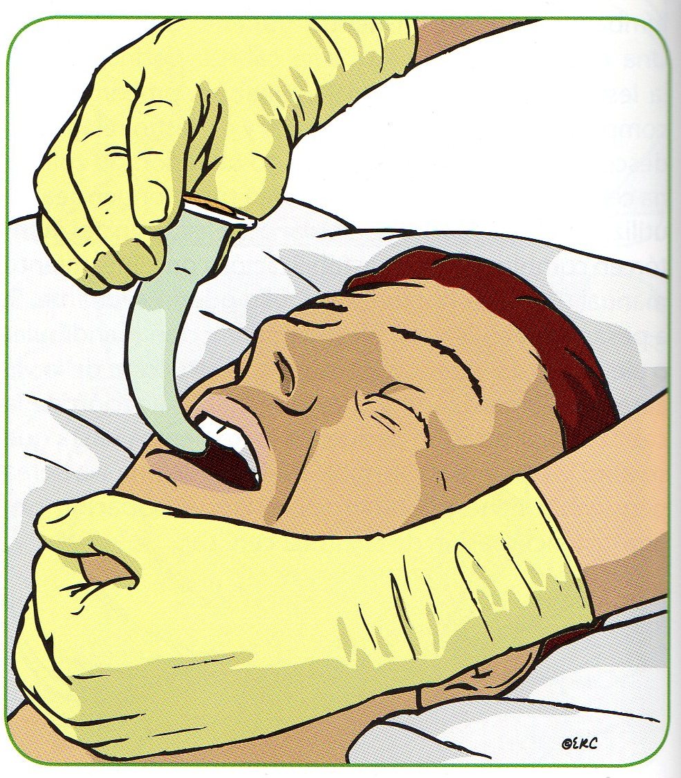 Utilización de cánulas oro o nasofaríngeas.