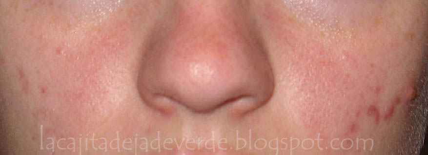 La cajita de Jade verde: Diario de una piel con acné-rosácea (III ...