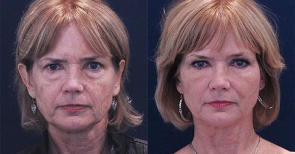 Obtaining A Chinese Acupressure Facelift With Face Aerobics Workouts ...