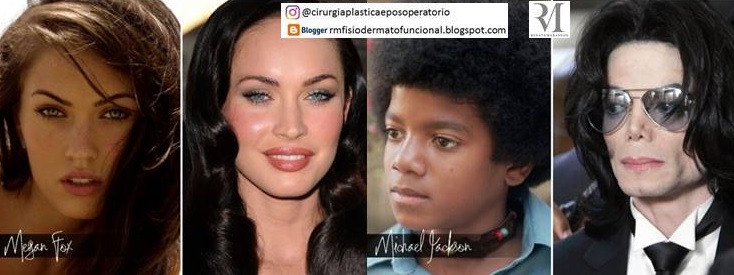 Fisioterapia em Pós Operatório de Cirurgias Plásticas: Transtorno ...