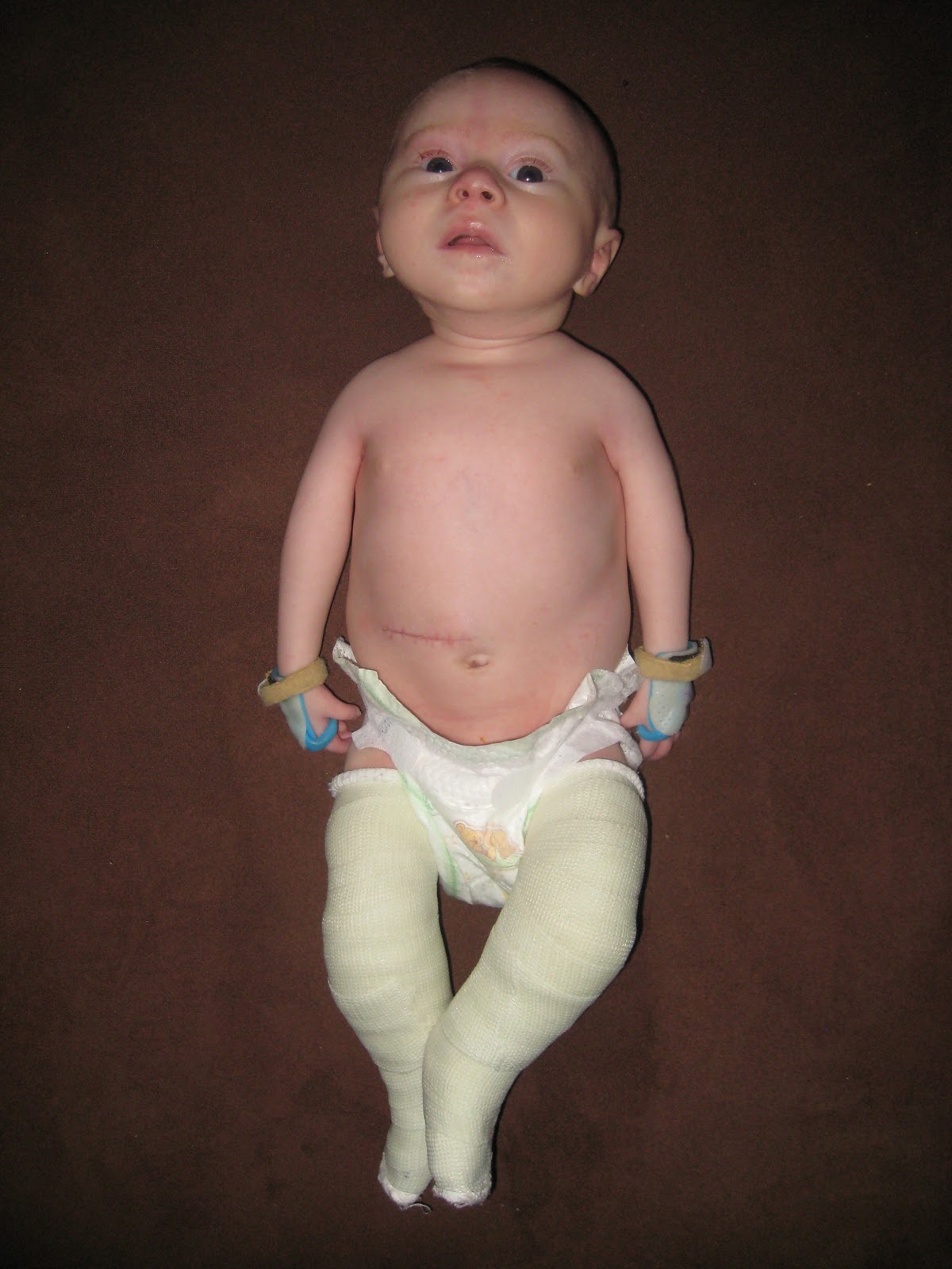 Sweet Analise Rose's Journey with Arthrogryposis, Amyoplasia type: Day ...