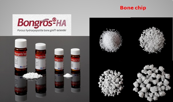 DAEWOONG PHARMA PHILIPPINES PRODUCTS: BONGROS - HA Bone Chip : Optimum ...