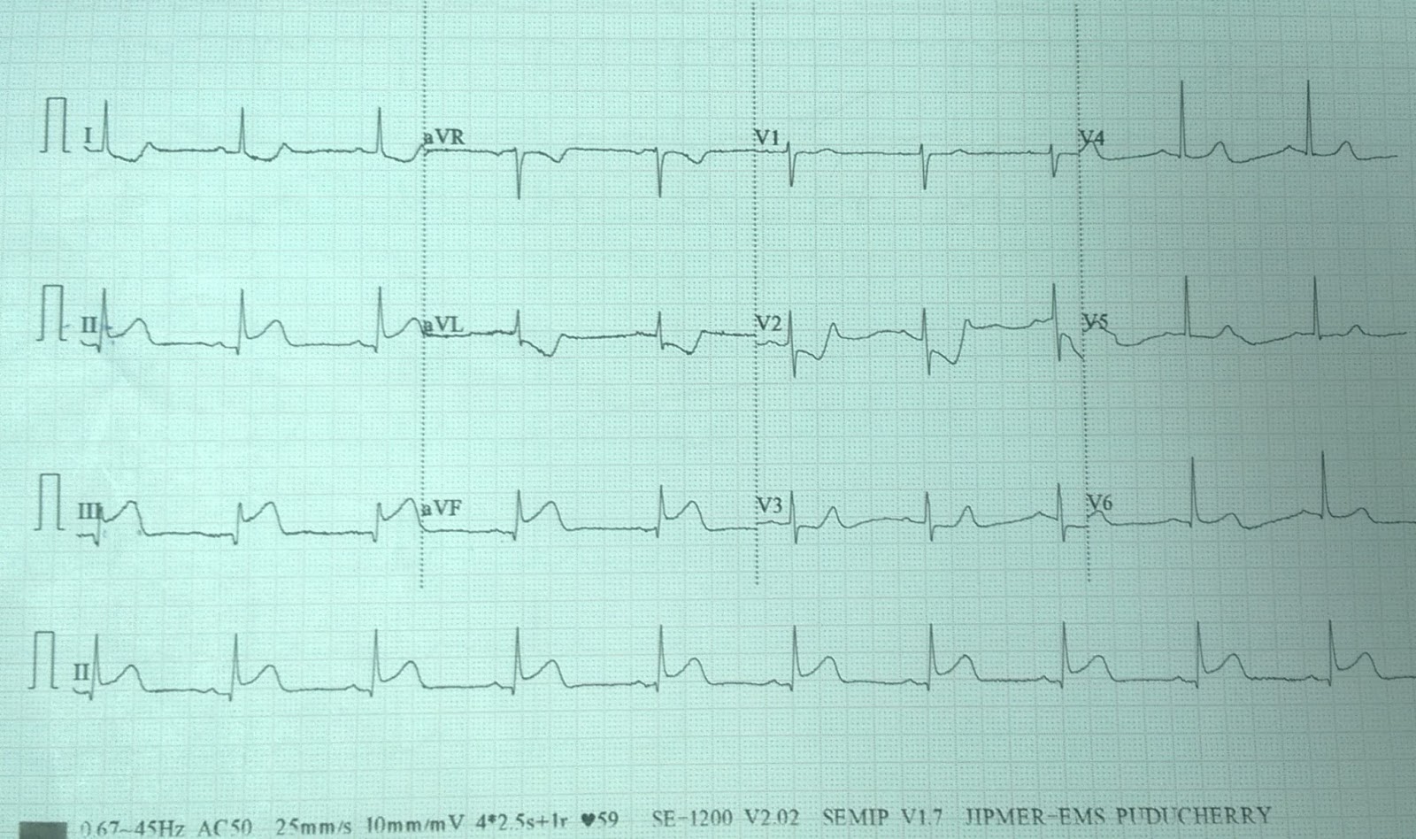 Cardiology window: Inferior wall with posterior wall with right wall ...