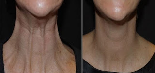 Get Rid Of Or Reduce Turkey Neck With Face And Neck Toning Exercises