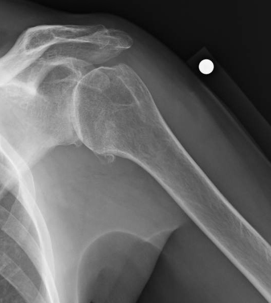 Shoulder Arthritis / Joint Replacement : Total shoulder - failure at 10 ...