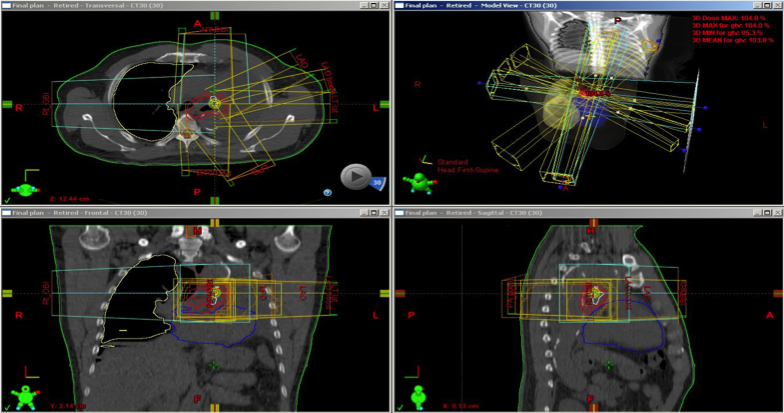 หมอมะเร็ง: การตรวจเพทสแกน (PET SCAN) กับโรคมะเร็ง