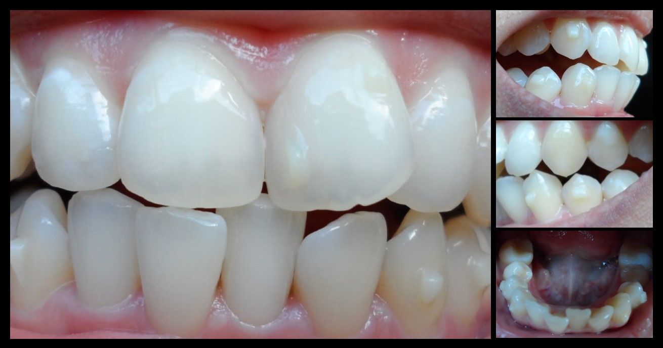 Ana's Invisalign Journey: Tray 4 & 5
