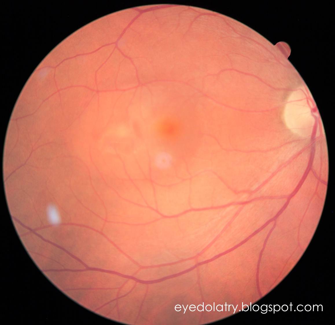 Retinal Photography - Eyedolatry