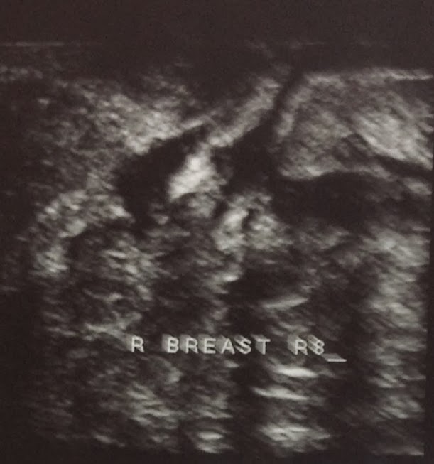 AUTOVACUNAS: Mastitis Infecciosa