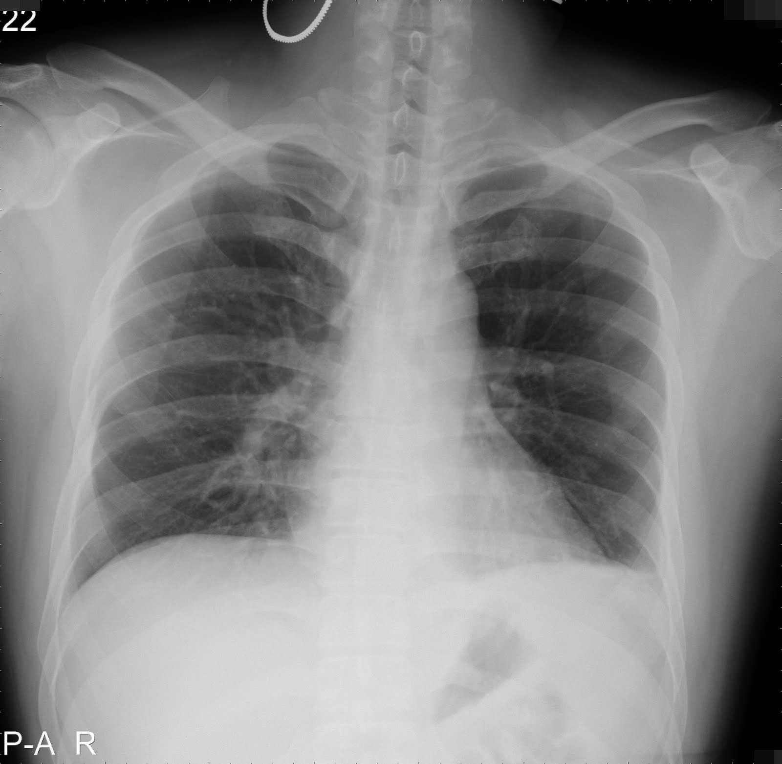 CXR 胸部x光判讀 pulmonary embolism