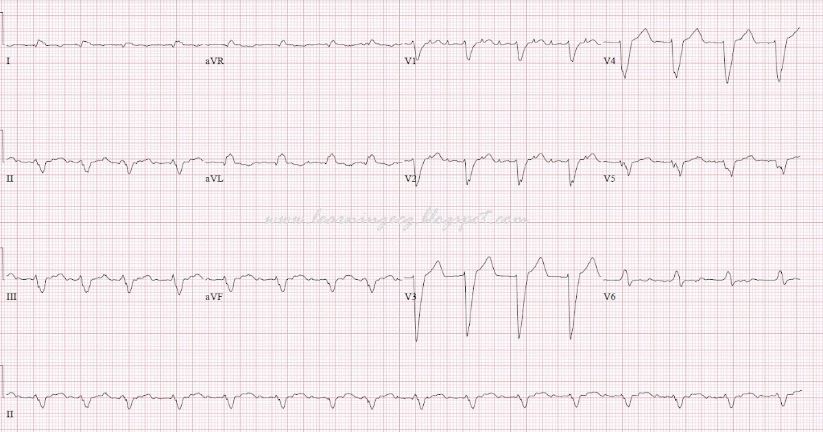 ECG Rhythms: Atrial Flutter (mis)interpreted as Sinus Rhythm