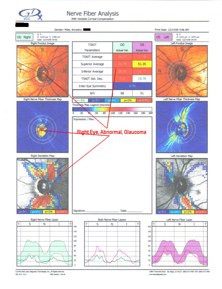 Warna Warni: GDX Glaucoma Test