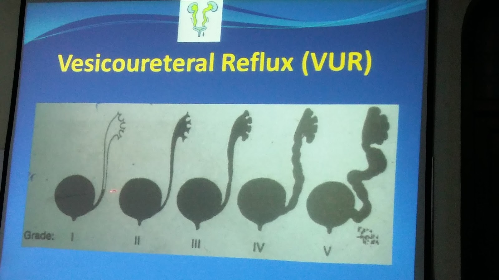 Lecture Slides : Paeds Surgery ; Vesicoureteral Reflux(VUR) And ...