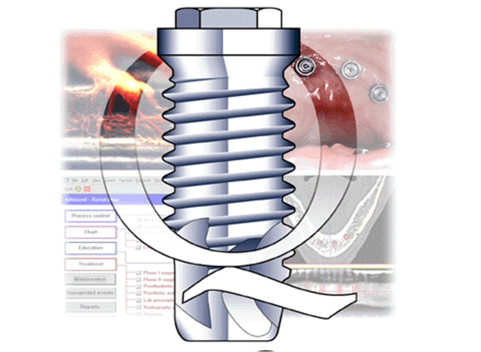 SevaDharma Dental Clinic: Dental Implant - OSTEOINTEGRATION