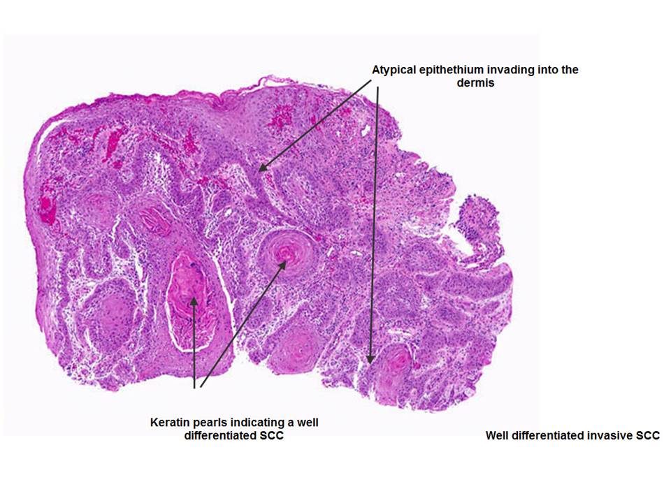 Dermpath Made Simple - Neoplastic: Squamous cell Carcinoma