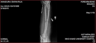 Worst Hand Forearm Injury Open fracture called Compound fracture ...