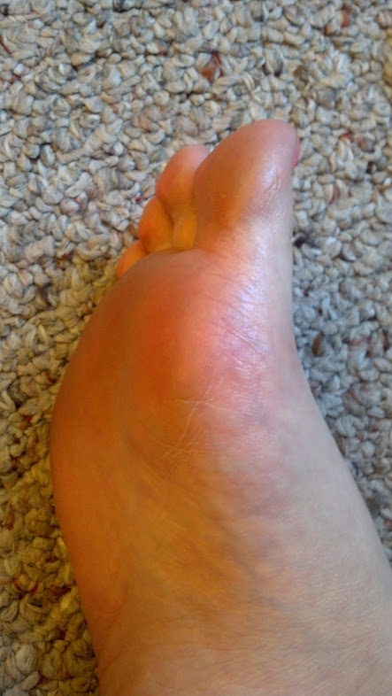 load Toe Skin Cracking Dry - loadcrackdance